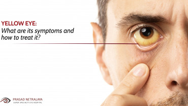 Are Yellow Eyes Normal? What Are Its Symptoms and Treatment