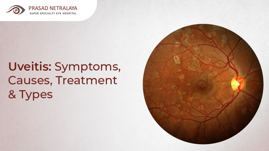 Uveitis: Symptoms, Causes, Treatment & Types - Prasad Netralaya